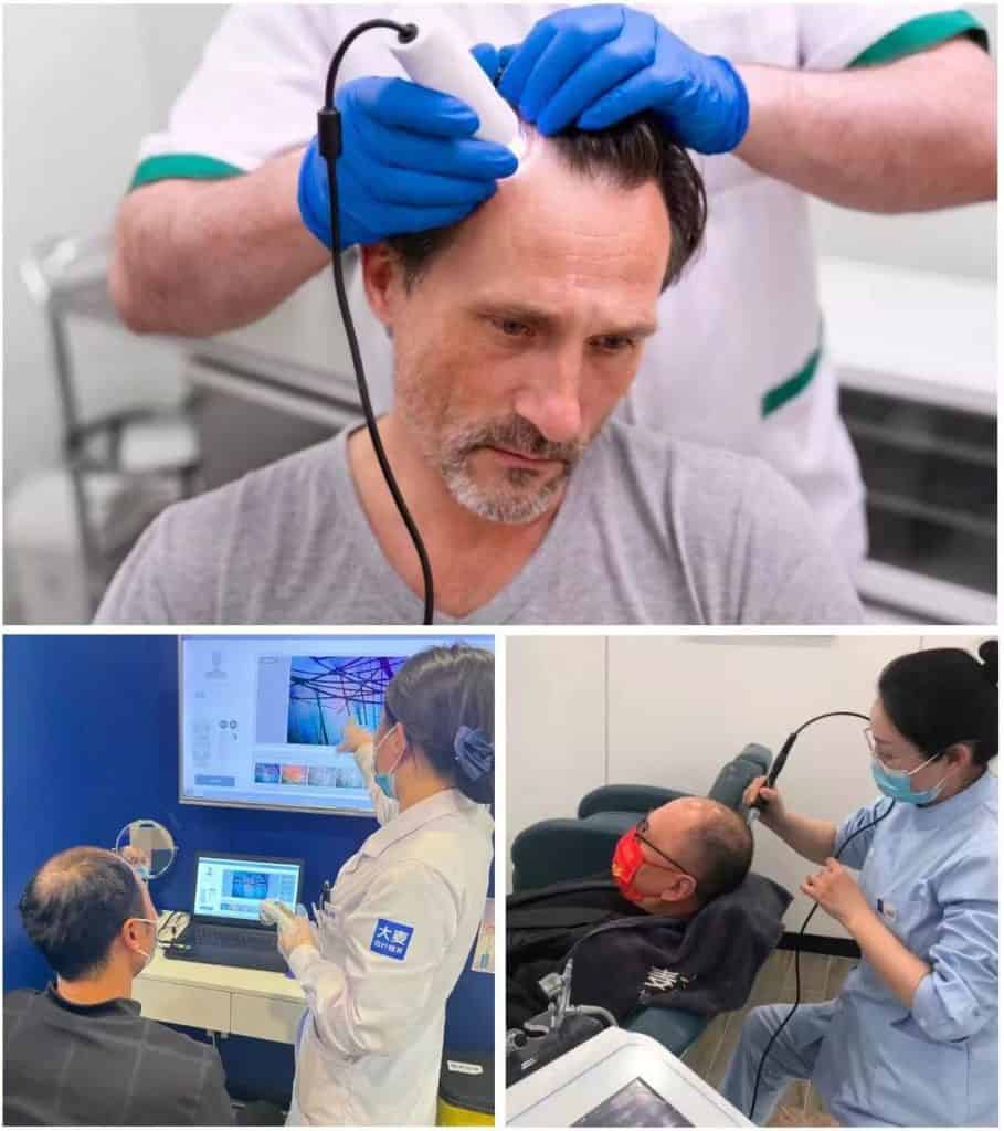 Microneedle Hair Transplant in China | Chengdu-Expat.com